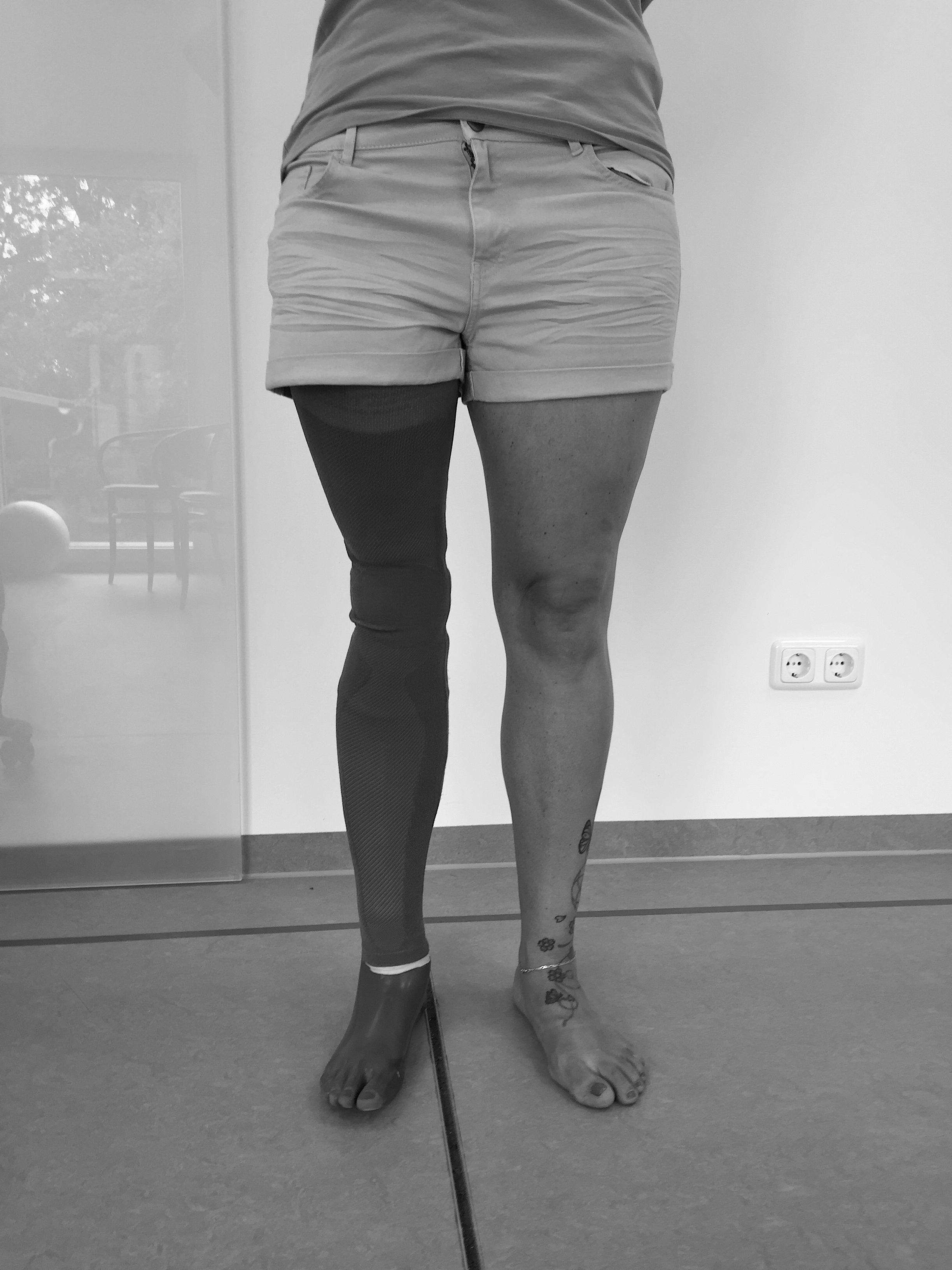 Orthobruns GmbH - Hüft-Ex Prothese